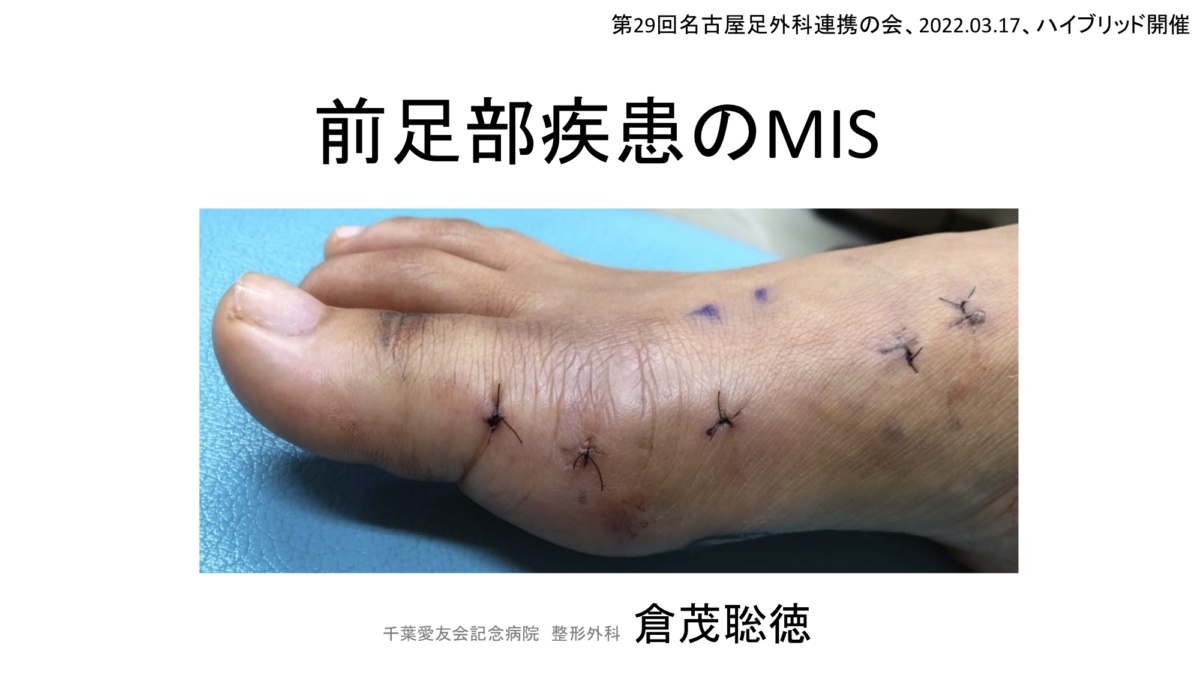 MIS足の外科センター MIS foot center